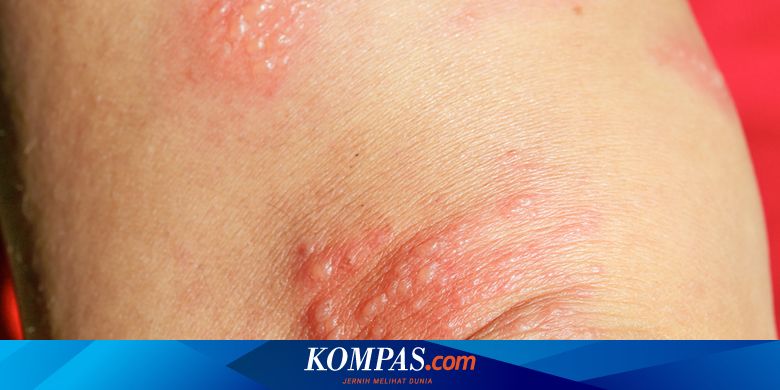 Penyakit Pemfigoid Bulosa - Gejala, Penyebab, Pengobatan - Kompas.com