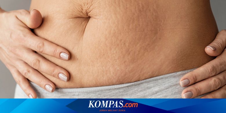 5 Penyebab Stretch Mark di Paha, Bisa karena Genetik