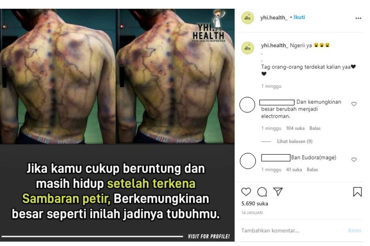 [HOAKS] Foto Badan Penuh Lebam Disebut karena Tersambar Petir