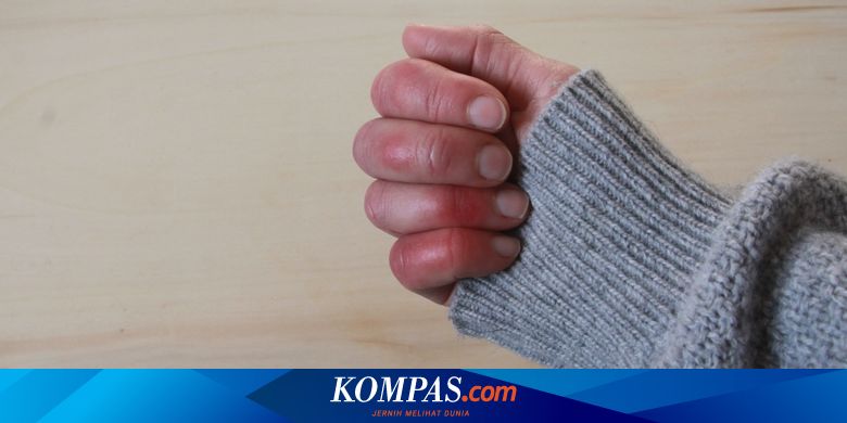 Apakah Frostbite Bisa Sembuh? Temukan Jawaban dan Pengobatannya