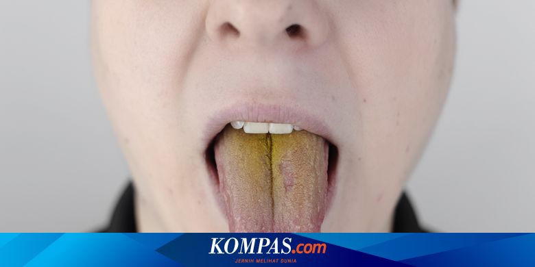 Penyakit Lidah Kuning - Gejala, Penyebab, Pengobatan - Kompas.com