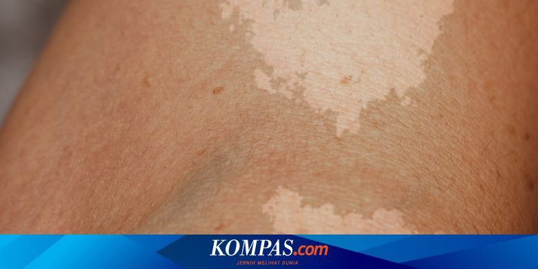 Panu: Penyebab, Gejala, Cara Mencegah, dan Mengatasinya