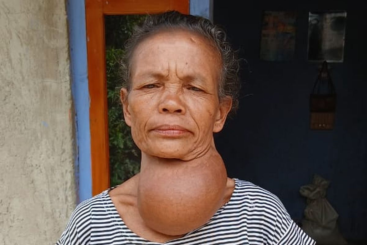 Perjuangan Mama Regina 24 Tahun Melawan Sakit Gondok: Saya Ingin Sehat...