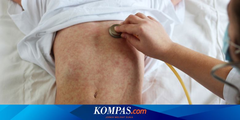 IDAI Ungkap Gejala Campak dan Komplikasi Berat yang Dapat Picu Kematian