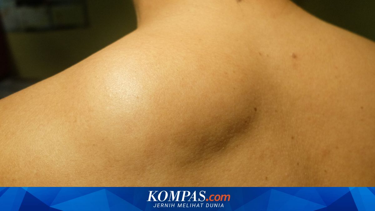 3 Cara Menghilangkan Lipoma, Tak Selalu Perlu Operasi