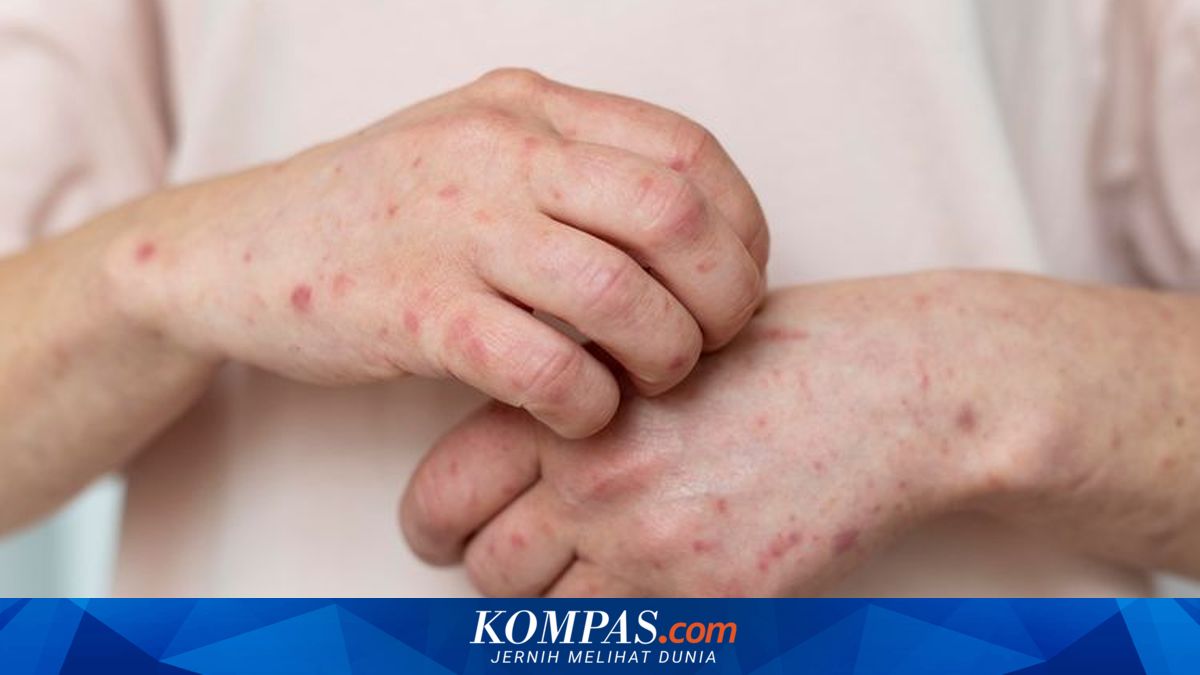 Gejala 3C, Cara Membedakan Campak dan Rubella