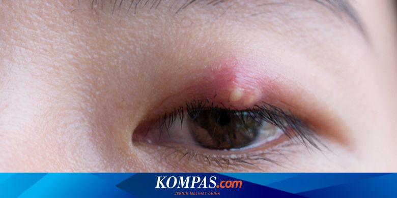 Kenali Apa itu Bintitan, Gejala, Penyebab, dan Cara Mengobatinya