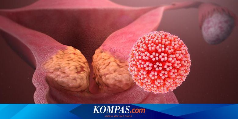 Apakah Infeksi HPV Bisa Disembuhkan? Simak Penjelasan Dokter Berikut…
