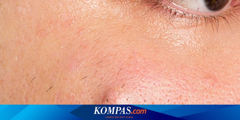 Penyebab Kista Epidermoid dan Kapan Harus ke Dokter