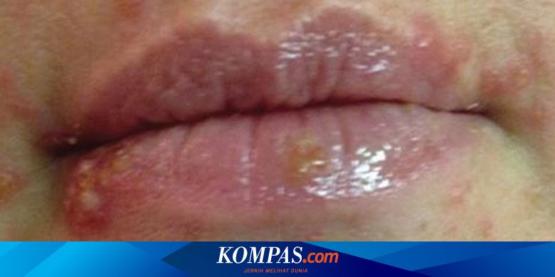 Sifilis: Gejala, Penyebab, Cara Mengobati, dan Cara Mencegah