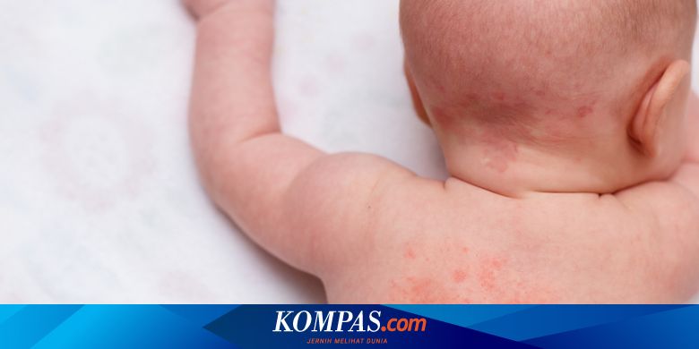 Penyebab Ruam di Kulit Bayi Menurut Dokter dan Cara Mengatasinya