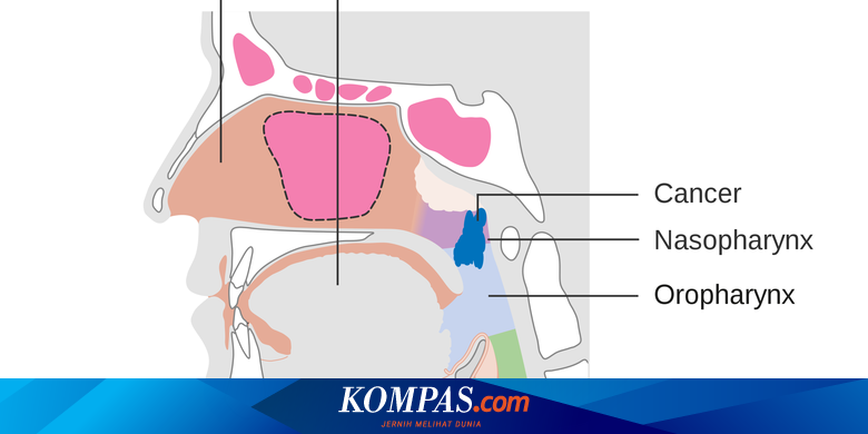 Kanker Nasofaring, Gejala, Penyebab, dan Perawatannya