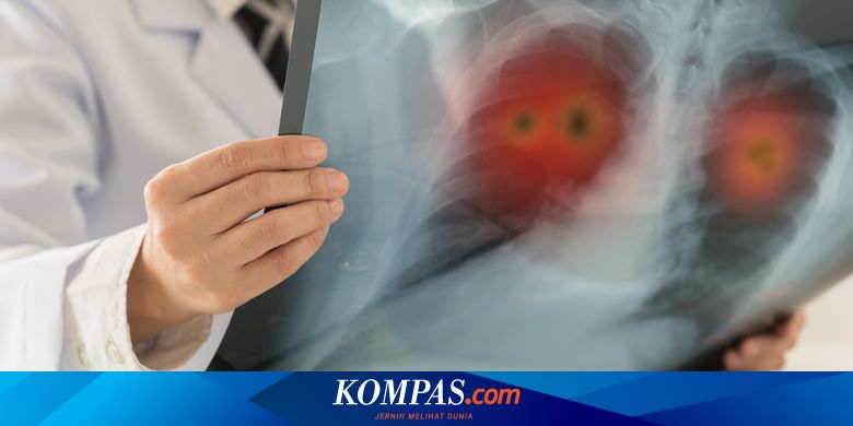 Penyebab Kanker Paru-paru, Merokok Jadi Pemicu Utamanya