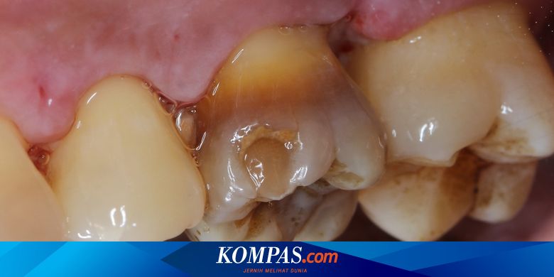 Penyebab Karies Gigi dan 4 Perawatan yang Bisa Dilakukan