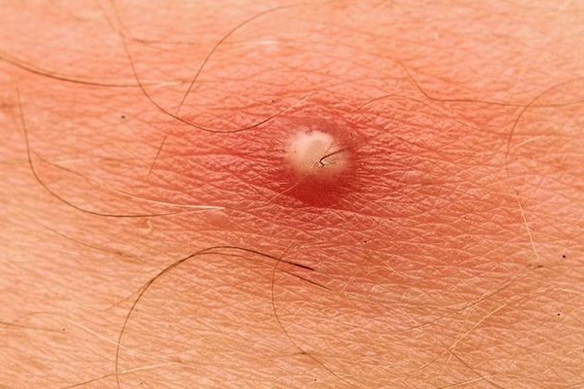 Ramai soal Bisul Pecah, Apakah Berbahaya? Ini Kata Dokter dan Cara ...