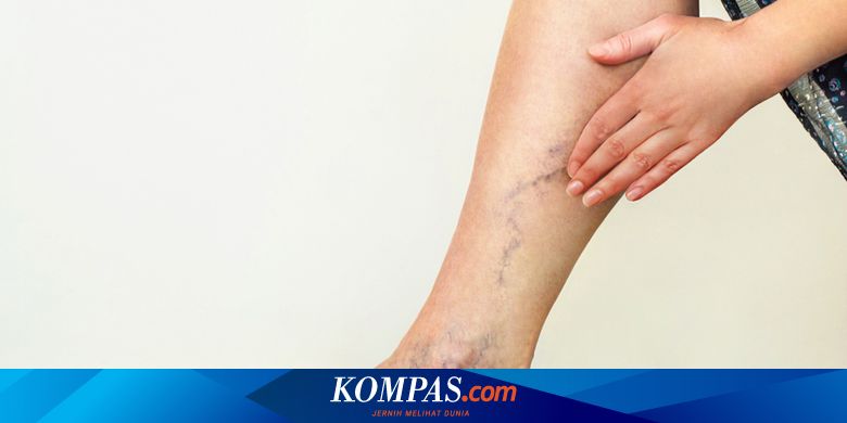 Mengenal Apa Itu Varises, Penyebab, Gejala, dan Cara Mengatasinya