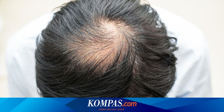 Kenali, 3 Jenis Kebotakan yang Umum Terjadi