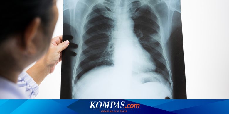 Simak Biaya Rontgen di Berbagai RS di Indonesia