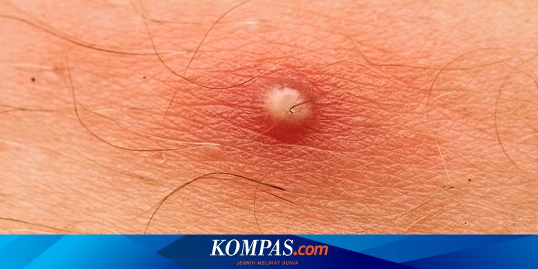 Penyebab Bisul dan Faktor Risikonya