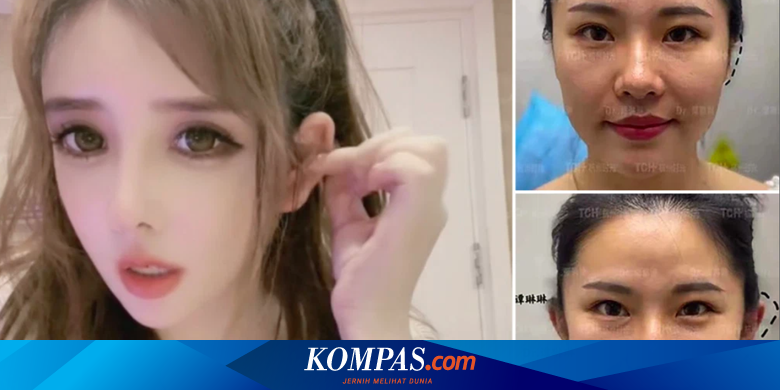 “Telinga Peri” ala Legolas Kini Jadi Tren Operasi Plastik Baru di China