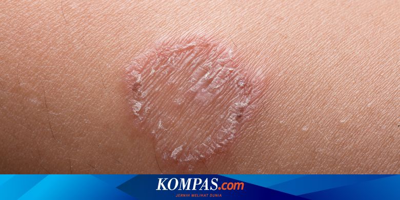 Mengenal Jamur Ringworm dan Cara Penularannya