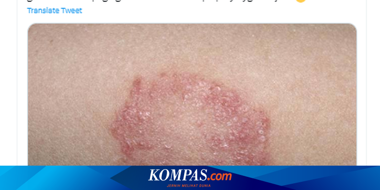 Ramai soal Jamur Ringworm, Apa Obatnya?