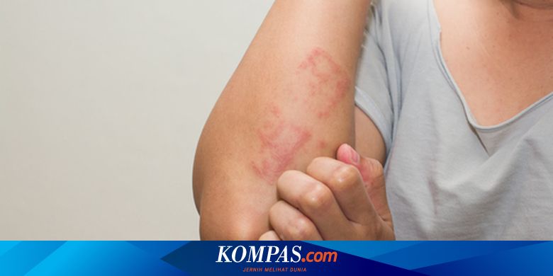 Eksim dan Stres, Apa Kaitannya?