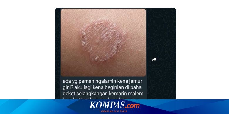 Apa Itu Ringworm pada Kulit? Begini Cara Pencegahan dan Pengobatannya