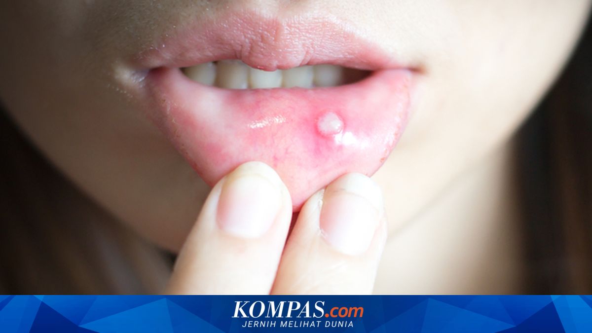 Cara Mengobati Sariawan di Bibir dengan Cepat dan Alami