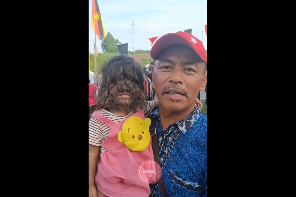 Kisah Bocah 2 Tahun asal Malaysia yang Dijuluki "Manusia Serigala", Orangtua Mengaku Sempat Stres