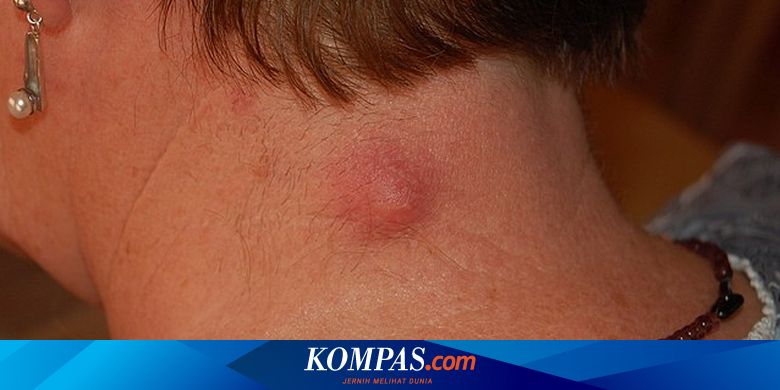 Apa Saja Jenis-jenis Kista?