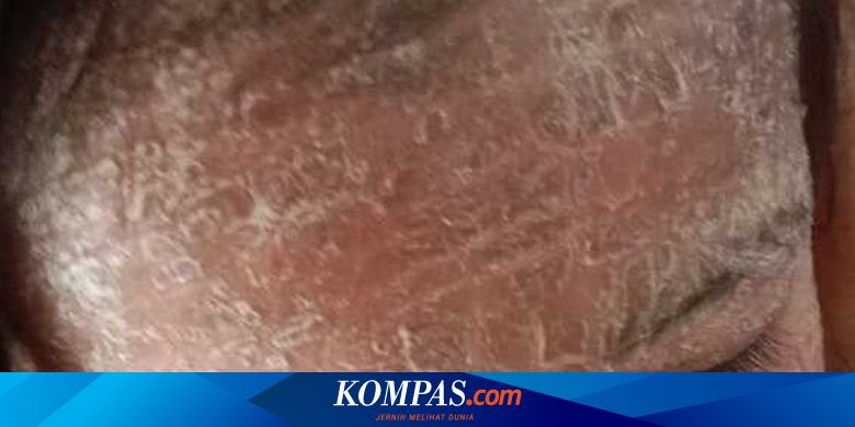 Anak Perempuan di Indramayu Derita Kelainan Kulit sejak Lahir, LPAI ...