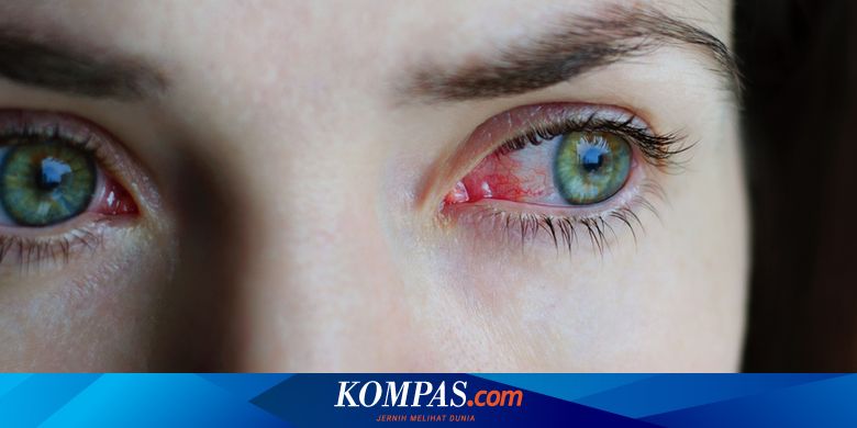 8 Penyebab Mata Merah dan Cara Mengatasinya