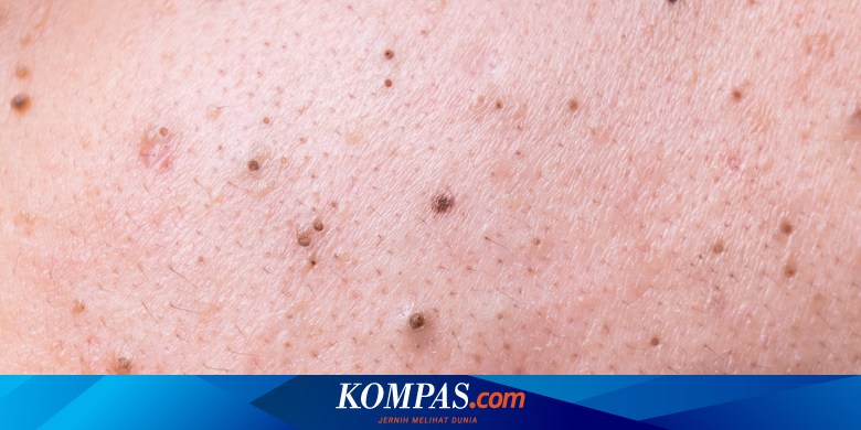 Ramai soal Bintik Hitam yang Tampak Masuk pada Kulit Punggung, Apa Itu?