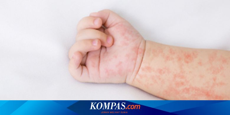 Berbagai Hal Seputar Campak yang Harus Orangtua Ketahui