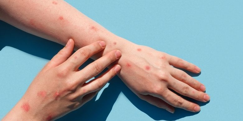 Indonesia Detects First Case of Monkeypox Virus