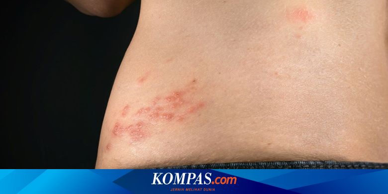 Mengenal Cacar Api, Penyakit Akibat Cacar Air yang Bisa Menyerang Lansia