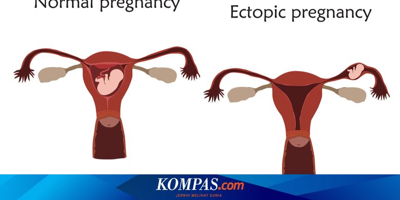 Penyakit Kehamilan Ektopik - Gejala, Penyebab, Pengobatan - Kompas.com