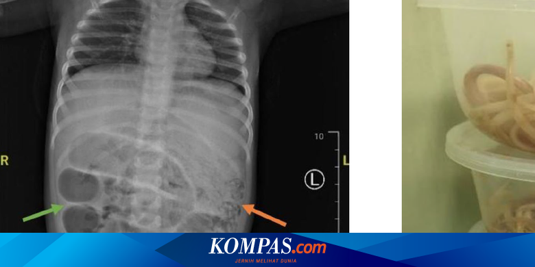 Perut Anak di Jember Penuh Cacing Ascariasis, Bagaimana Penularannya?