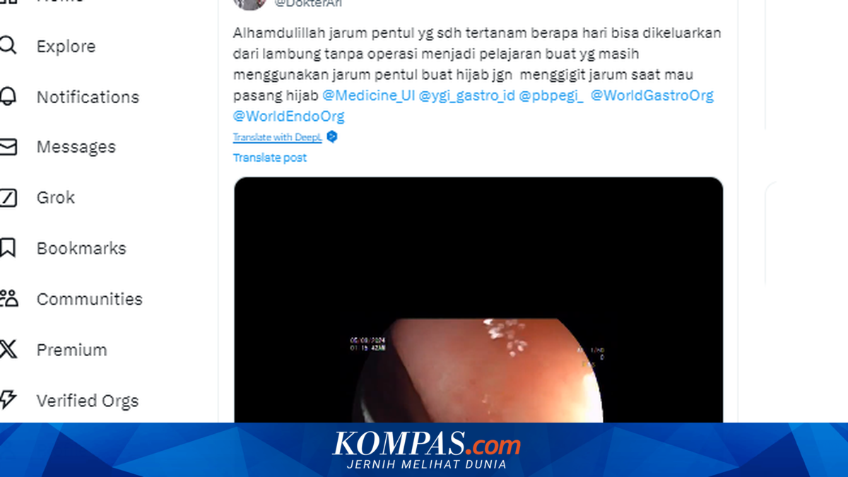 Waspada, Jarum Pentol Tak Sengaja Tertelan hingga Lambung Saat Pakai Jilbab
