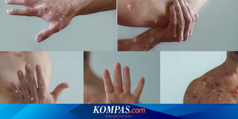 Bintik Cacar Monyet seperti Apa? Ini Penjelasan Dokter...