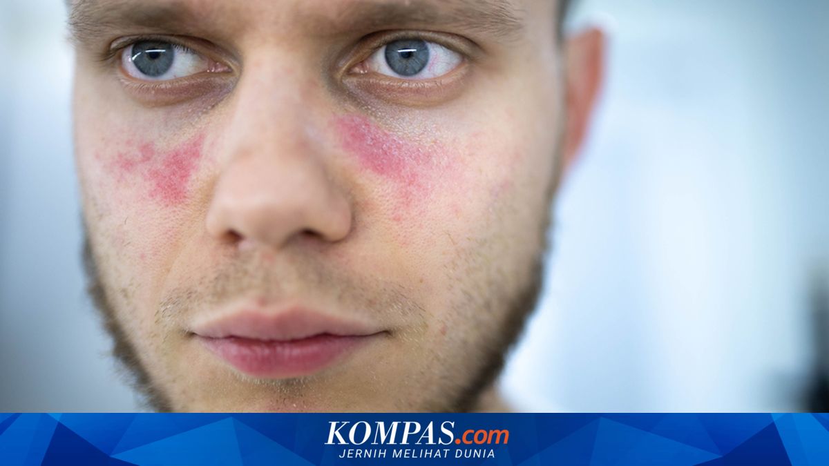 Apa Itu Penyakit Lupus? Berikut Gejala, Penyebab, Komplikasi, dan ...