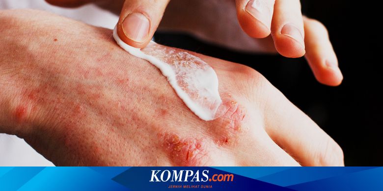 Penyakit Eksim - Gejala, Penyebab, Pengobatan - Kompas.com