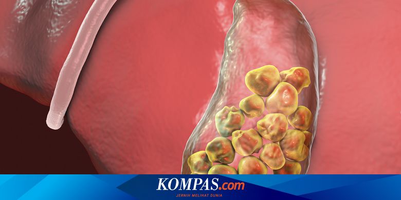Batu Empedu Bisa Keluar dengan Cara Apa? Simak Penjelasannya Berikut