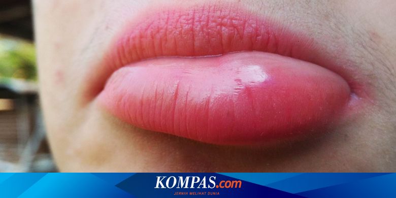 Penyakit Bibir Bengkak - Gejala, Penyebab, Pengobatan - Kompas.com