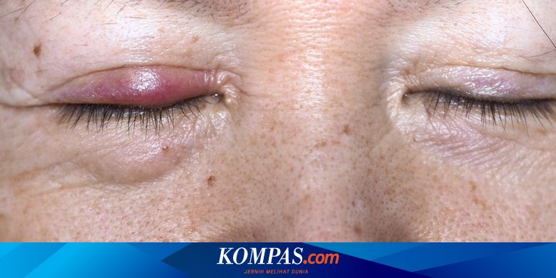Apa itu Bintitan di Kelopak Mata Dalam, Gejala, dan Cara Mengatasinya