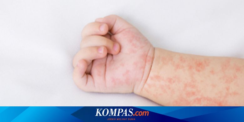 Apa Saja Tanda Penyakit Campak pada Anak Akan Sembuh?