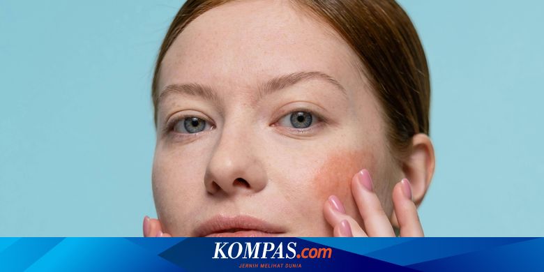 Tak Hanya Bikin Muka Merah, Rosacea Bisa Ganggu percaya Diri hingga Depresi