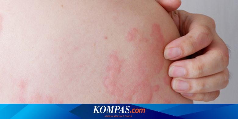 Gatal-gatal karena Stres, Apa Saja Cirinya?