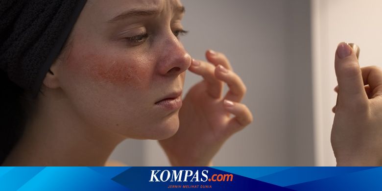 6 Penyebab Kulit Belang, Tak Hanya Sinar Matahari